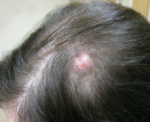 Kystes sur le cuir chevelu : causes et symptômes - dr-paraskevas